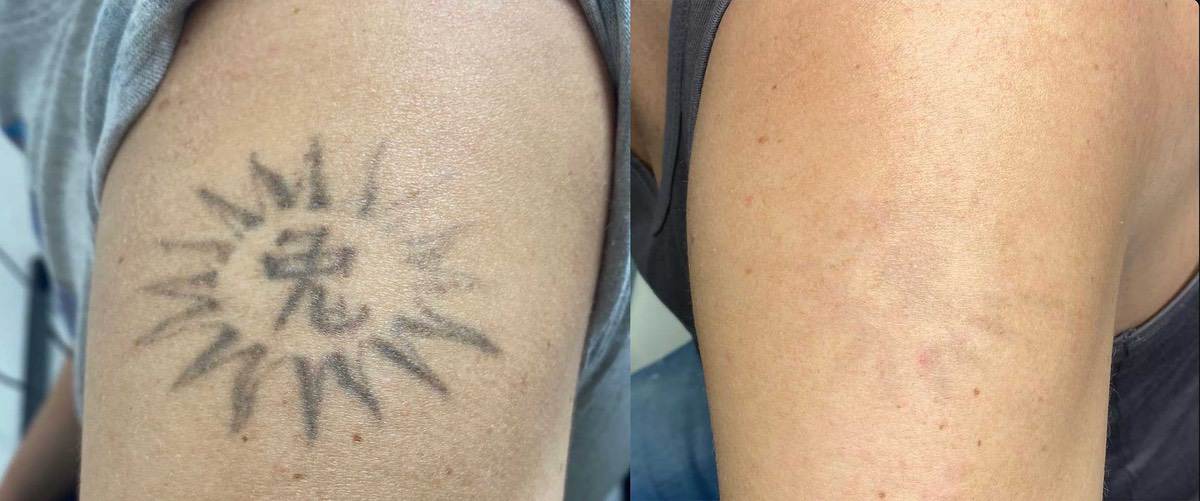 Laser Tattoo Removal Treatment In London Harley Street